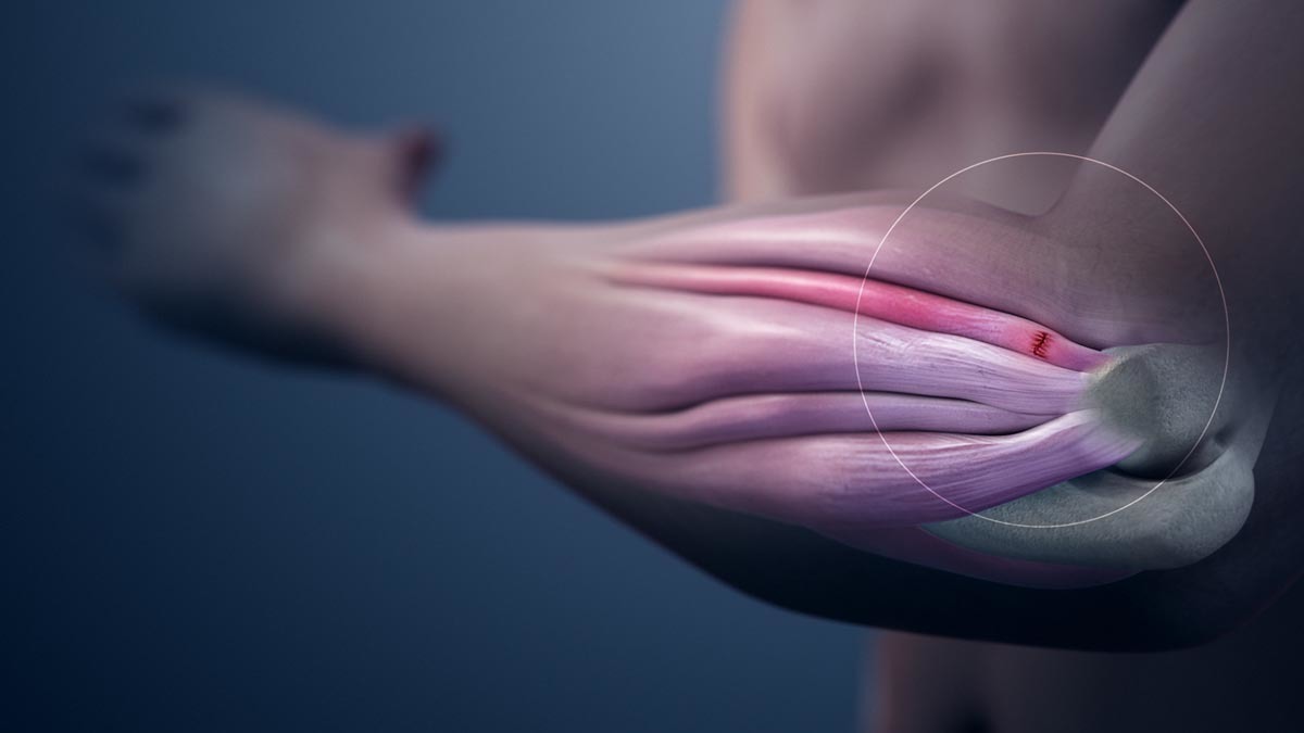 Tendinitis vs Tendinosis | Sun Chiropractic